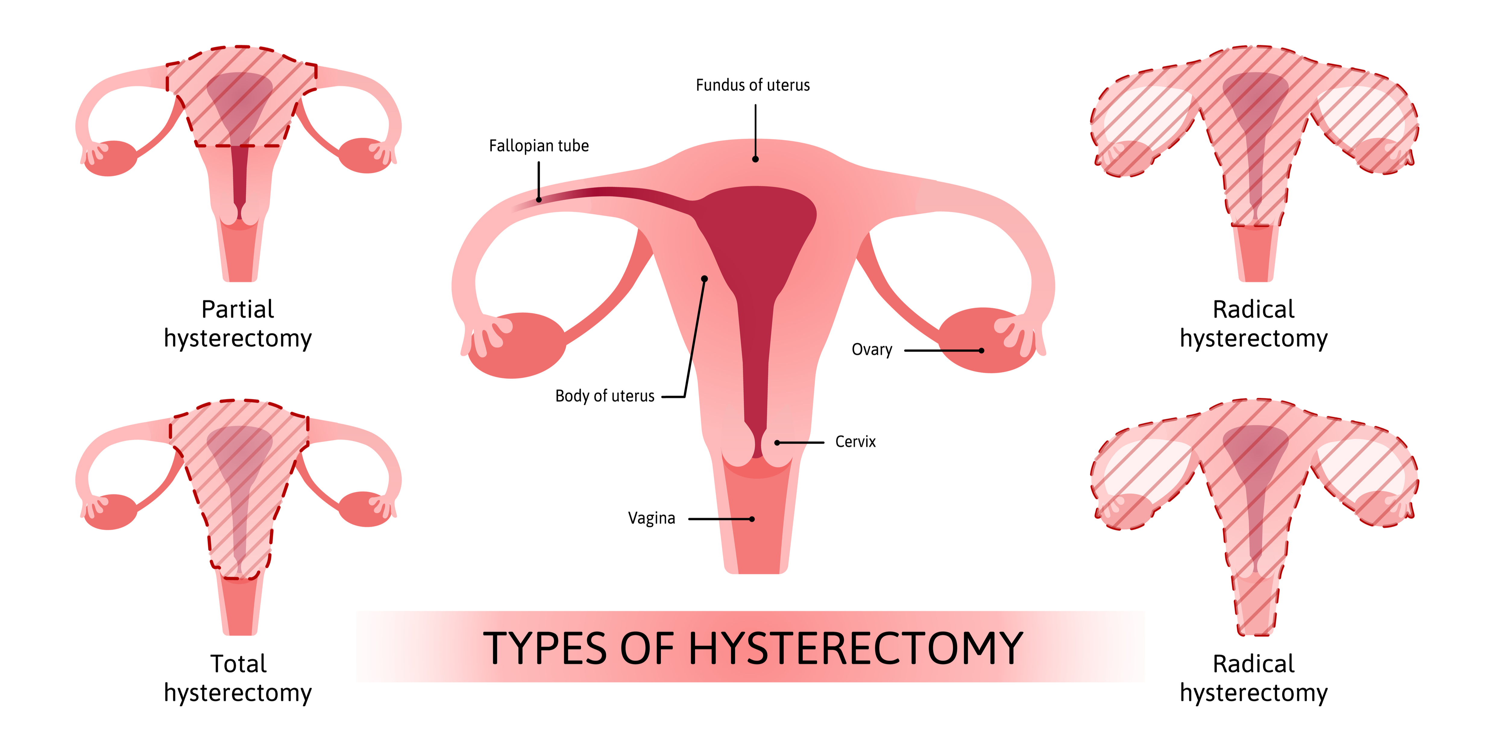 Open Hysterectomy Understanding What It Means